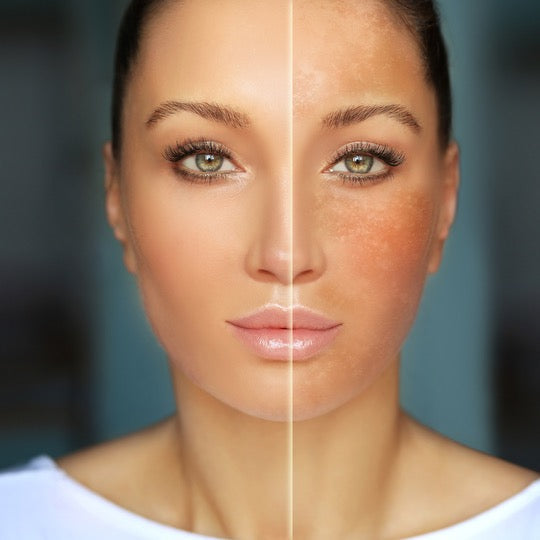 Understanding and Treating Melasma and Hyperpigmentation: Your Path to ...